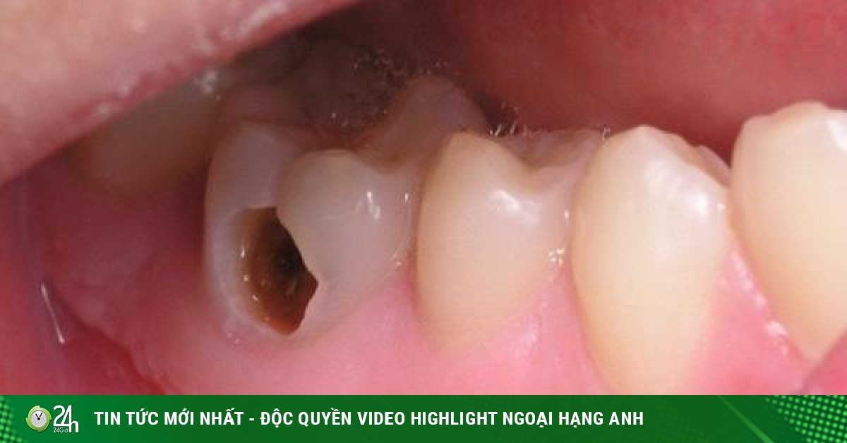 6 bài thuốc nam đơn giản, dễ kiếm chữa đau răng