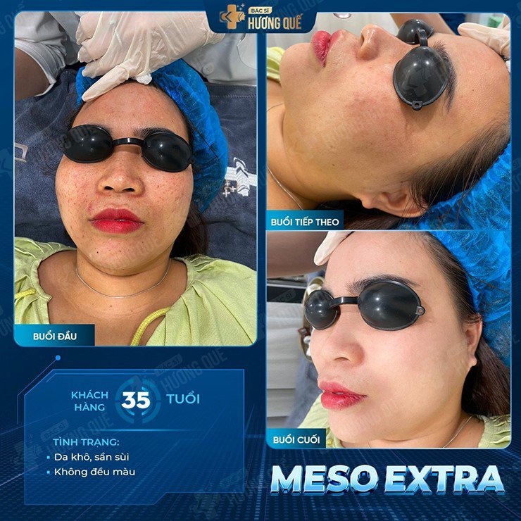 Những lợi ích không tưởng của Meso Extra đối với làn da - chia sẻ từ ...