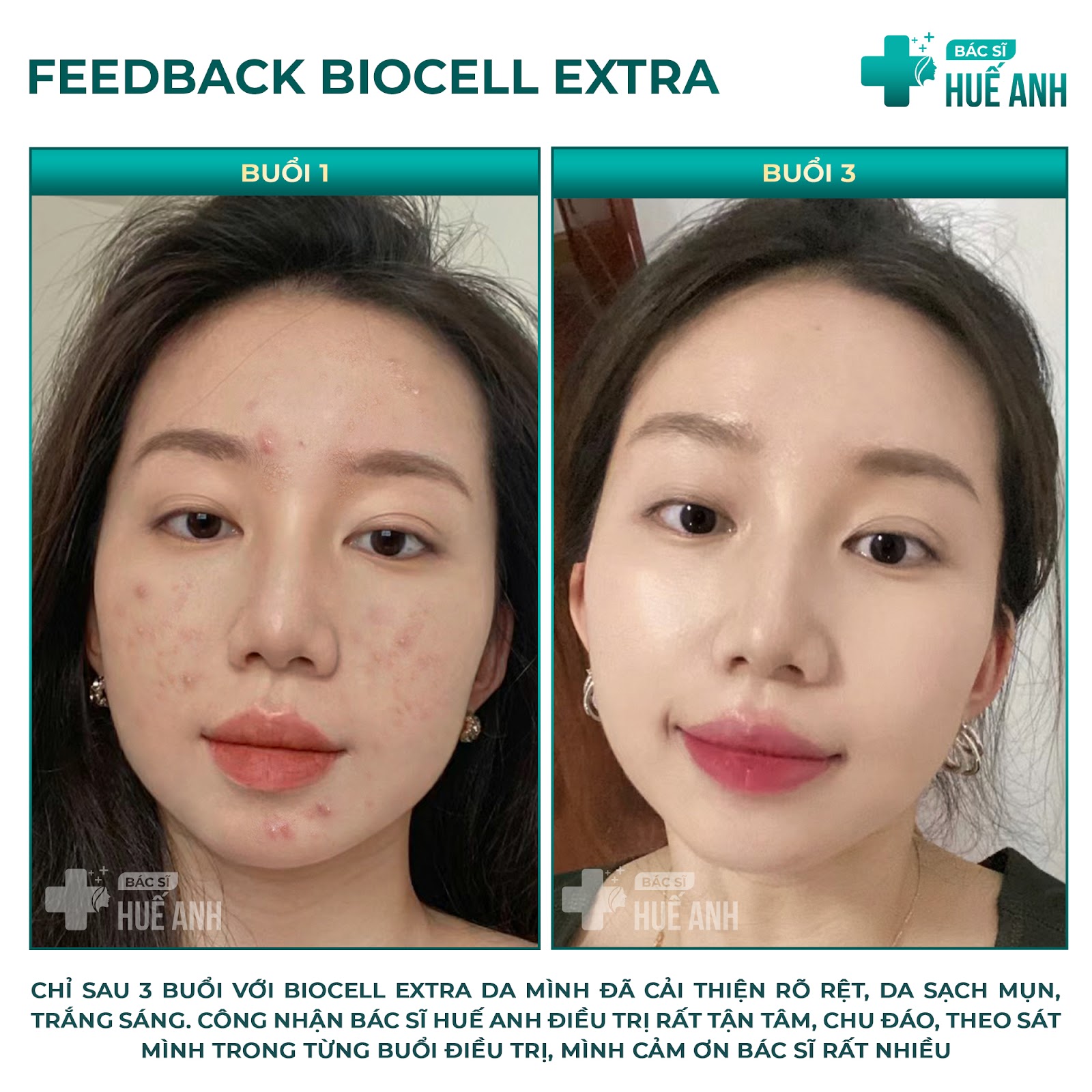 Căng bóng da không xâm lấn Biocell Extra - Tương lai của thẩm mỹ hiện đại