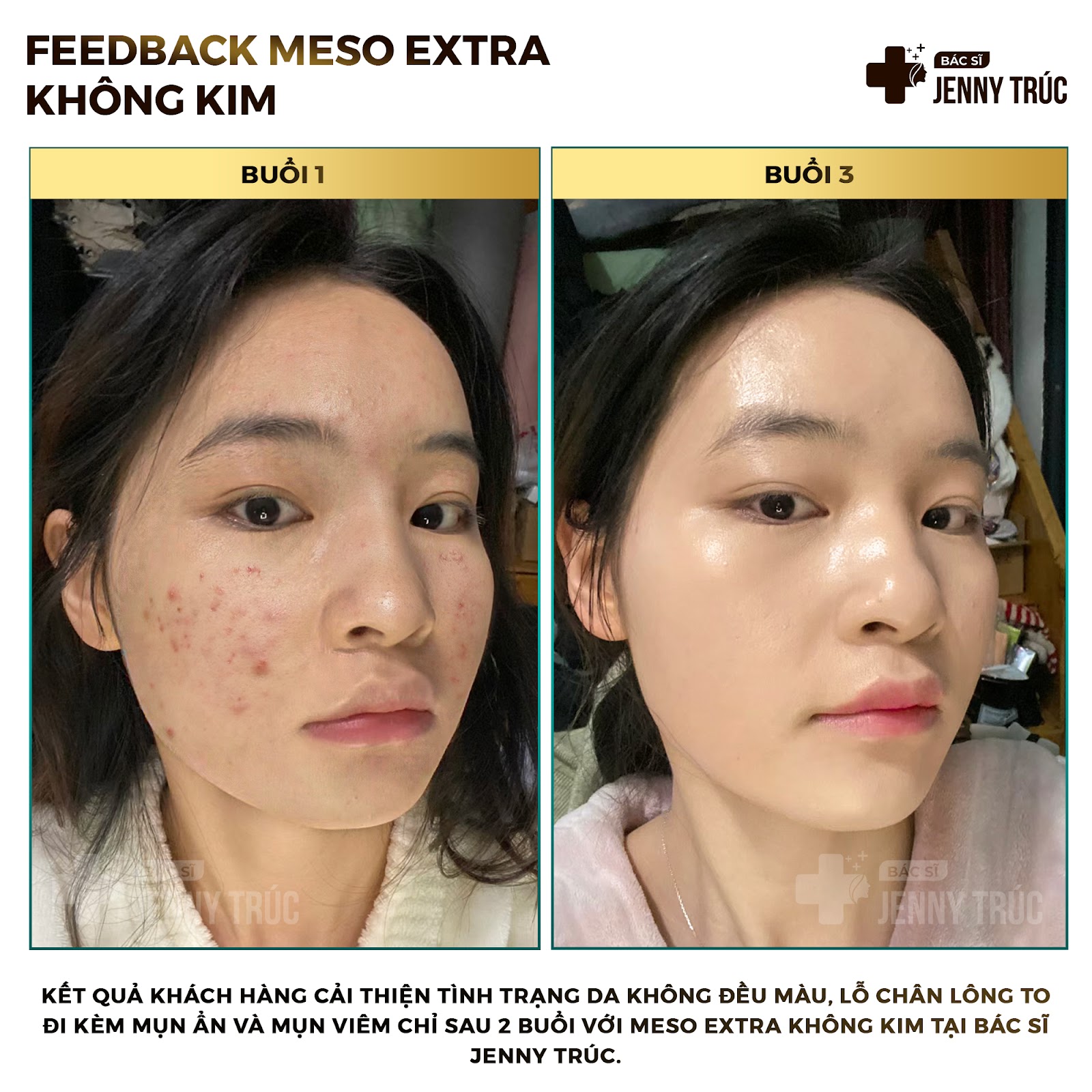 Cấy căng bóng da Meso Extra không kim có thực sự hiệu quả? Bác sĩ da ...