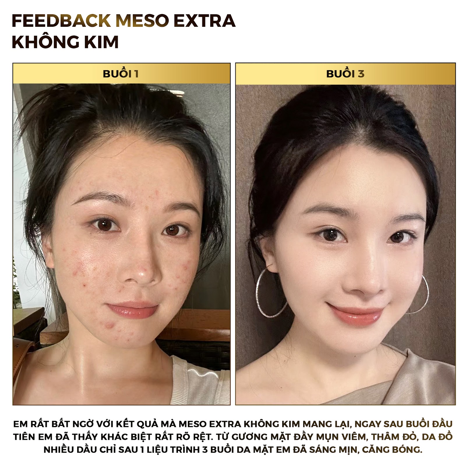 Bác sĩ Jenny Trúc giải mã sức hút của phương pháp căng bóng da Meso Extra không kim