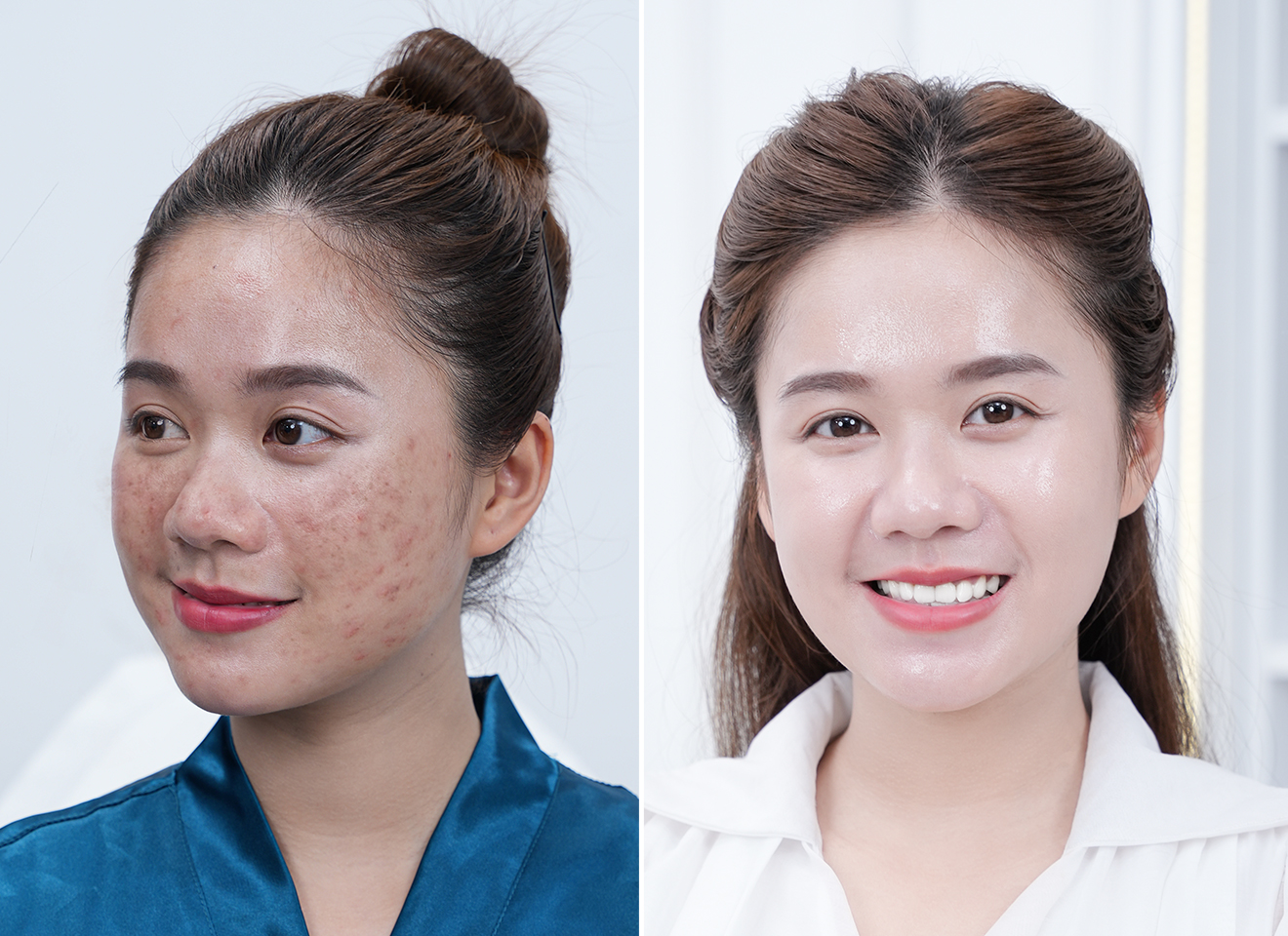 Top 3 lợi ích không tưởng khi cấy Meso Extra không kim lưu giữ tuổi xuân