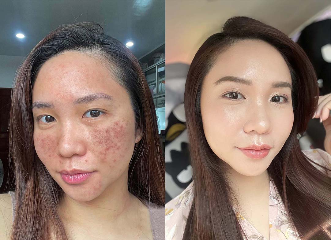 Meso Extra không kim được ưa chuộng trong thẩm mỹ da không xâm lấn