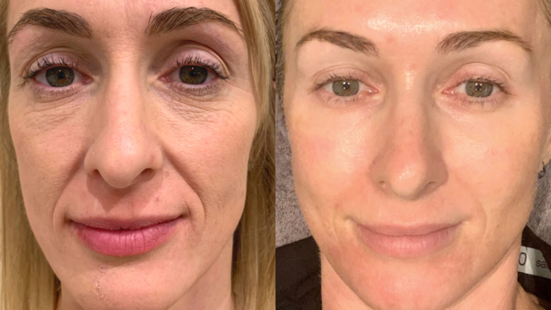 Vì sao Mezo Pro là siêu công nghệ trong trẻ hóa - xóa nhăn?