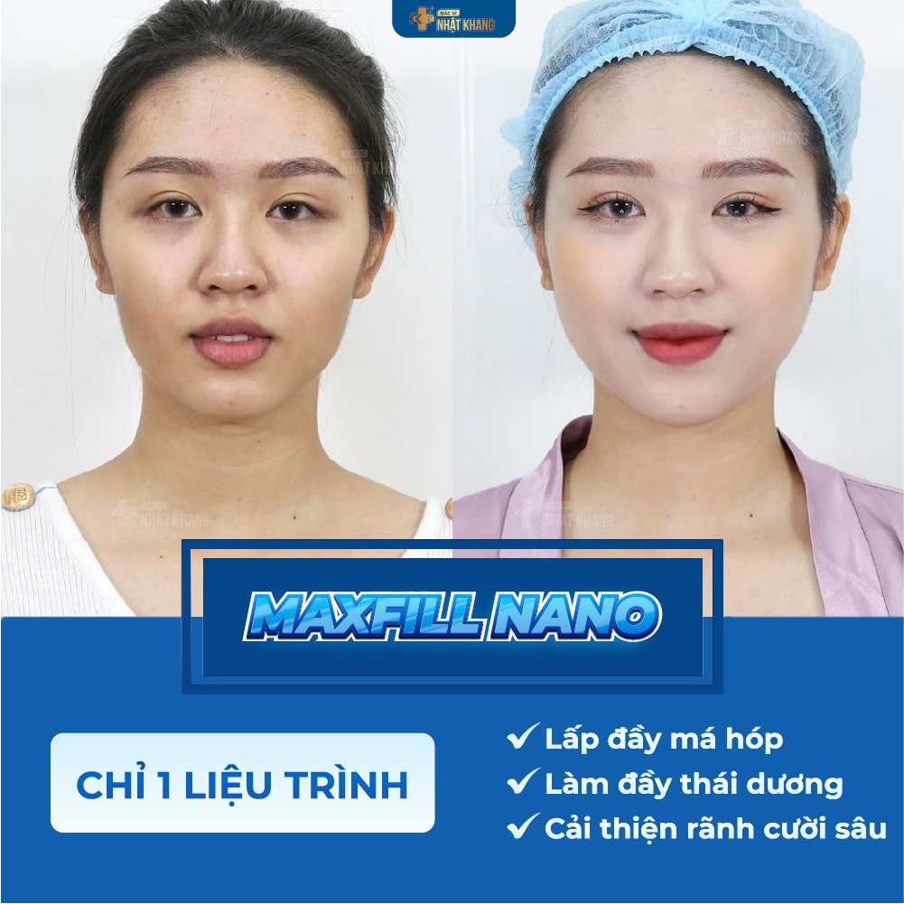 Maxfill Nano - Bí mật của vẻ đẹp không tuổi dưới góc nhìn của chuyên ...